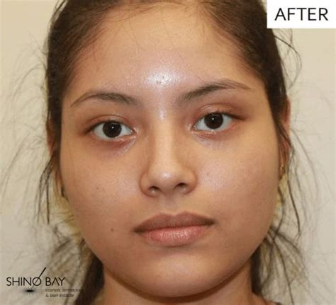 SmartSkin™ CO2 Laser - Shino Bay