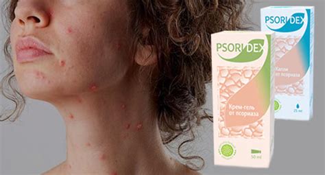 Psoridex от псориаза «крем-воск» особенности, комплекс, количество ...