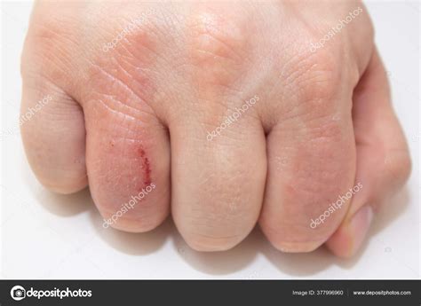Handdermatitis Hand Ekzeme Geschlossen Auf Weißem Hintergrund ...