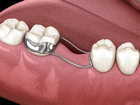 Hilo dental: tipos, usos y recomendaciones | Clínica dental Tiiz