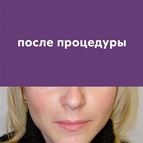 Лазерное лечение пигментации кожи в Минске