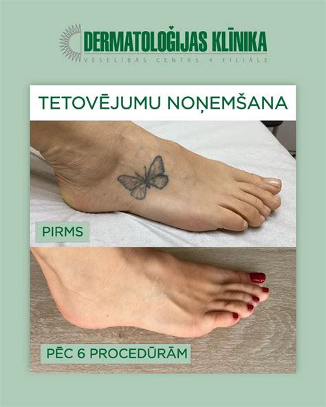 Удаление татуировок | Nasha