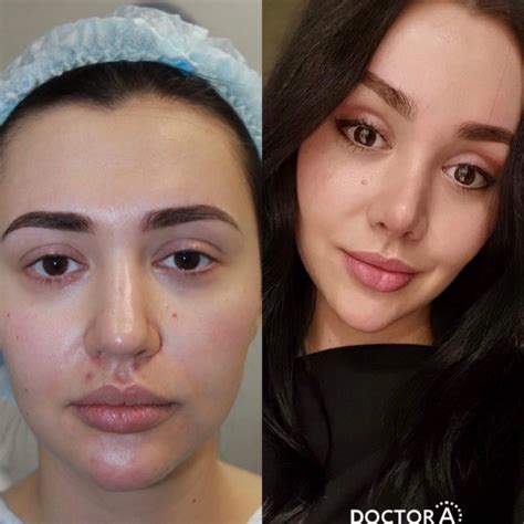 Костная мозоль после ринопластики