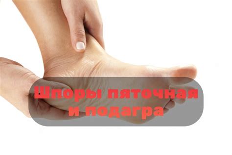 Подагра и шпора на пятке: причины и лечение пяточной шпоры при подагре