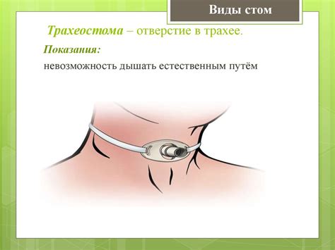 Виды стом - презентация онлайн
