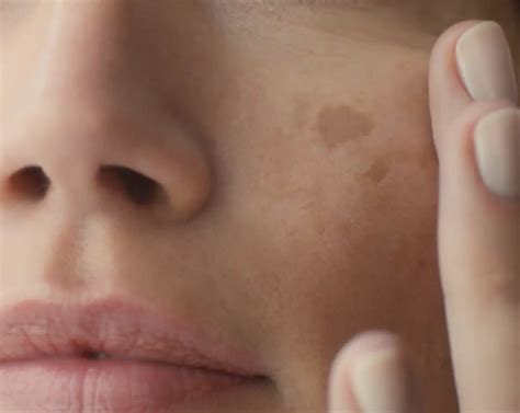 ¿Cuáles Son Los Tipos de Manchas Que Aparecen en la Cara? - NIVEA
