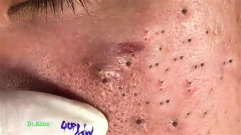 Enjoy with Remove Blackheads on Face Easy, Millions of Blackheads on ...