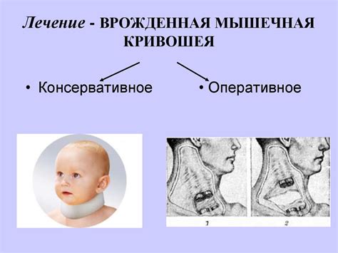 Кривошея - презентация онлайн