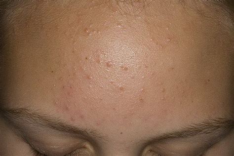 ищу стратегию: как избавиться от прыщей и черных точек | Covering acne ...