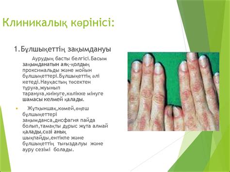 Дерматомиозит - презентация онлайн