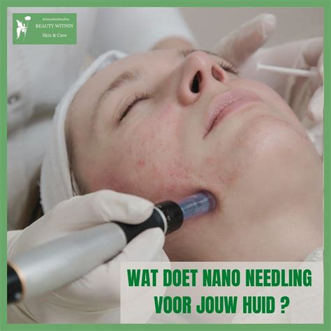 Nano Needling gezichtsbehandelingen bij schoonheidssalon Beauty Within ...