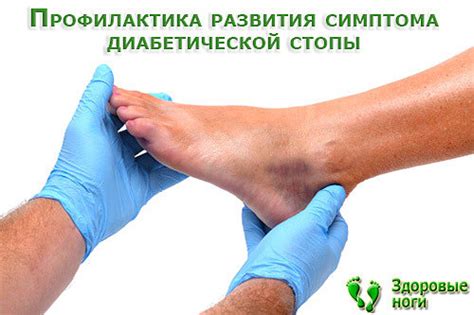 Памятка: профилактика развития синдрома диабетической стопы при ...