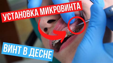 Микровинт для брекетов. Микроимплантация в ортодонтии. - YouTube