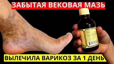 Забытая МАЗЬ От ВАРИКОЗА! Всего 1 БАНОЧКА и Через НЕДЕЛЮ Ножки Были ...