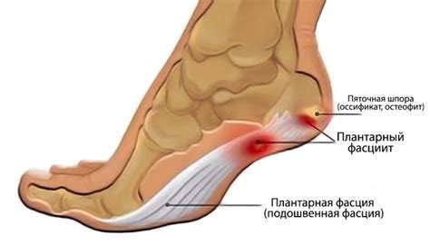 Пяточная шпора фото, симптомы и лечение в домашних условиях
