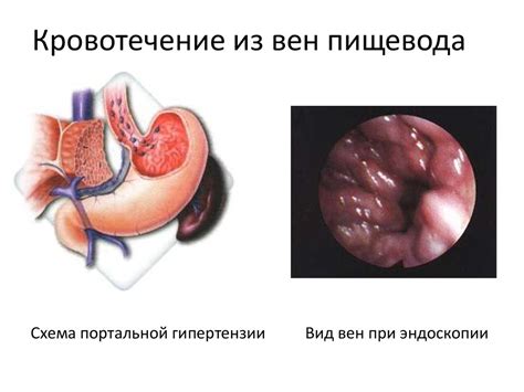 Кровотечения из верхних отделов ЖКТ - презентация онлайн