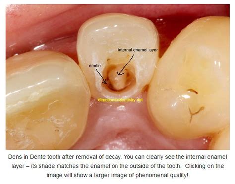 ORAL MEDICINE: Dens In Dente – Maxillary Lateral Incisor - Odontología ...