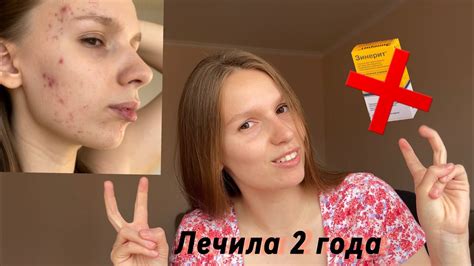 Как избавиться от акне | 2 лучших средства от прыщей - YouTube