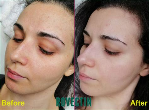 Rovectin Cica Care Balm - review with before&after