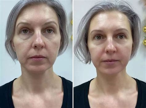 ️ Результат процедуры SMAS лифтинг на аппарате АЛЬТЕРА Каждая женщина ...