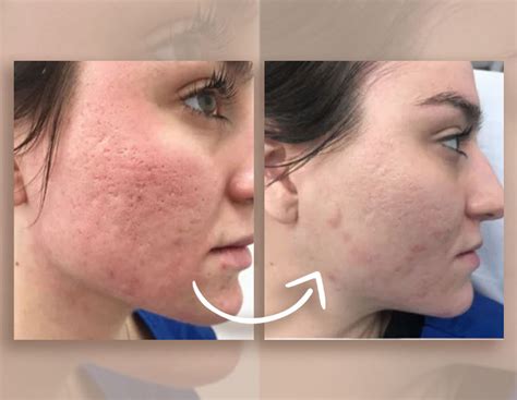 Dermapen - Pro Age Clinic - UAE