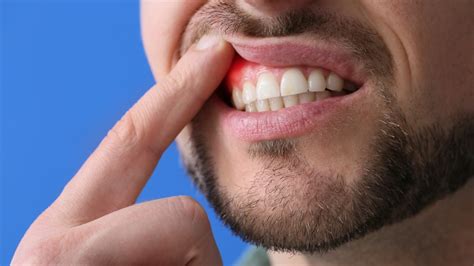 Apakah Vitamin C Bisa Menyembuhkan Gusi Bengkak? - KlikDokter