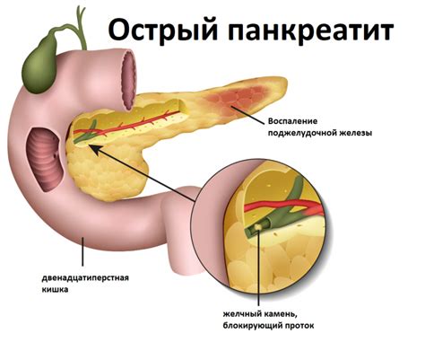 Диета при панкреатите: что можно кушать при воспалении поджелудочной ...