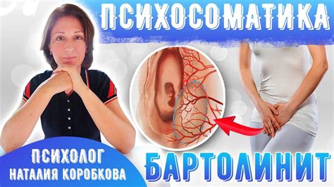 Воспаление бартолиновой железы / Бартолинит / Сухость влагалища # ...