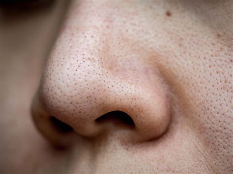 How To Get Rid Of Blackheads On My Arms at Robert Herron blog
