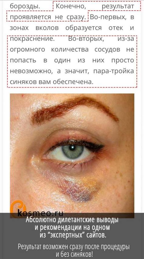 Как быстро убрать фингал под глазом в домашних условиях