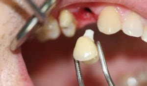 Стоматологический цемент для выпавших коронок: как выбрать и ...