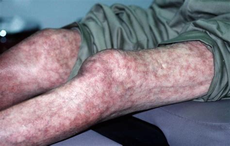 Mottled skin or livedo reticularis causes, diagnosis and treatment