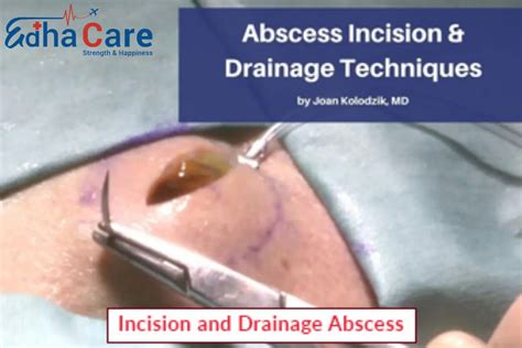 Incision And Drainage Limited Incisional Drainage And