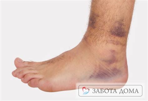 Появление синяков у лежачего пациента: механизм образования гематом ...
