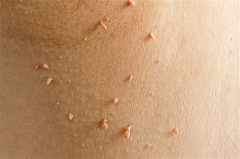 Skin Tags - Sun & Skin Medical Centre