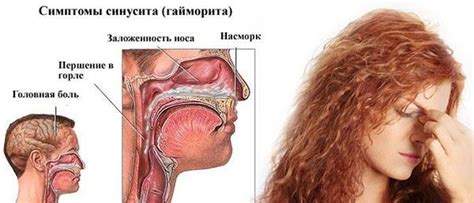 Синусит – лечение в ЦЭЛТ, ЯМИК-процедура.
