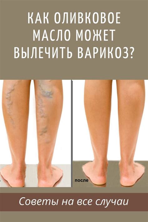 Как оливковое масло может вылечить варикоз? | Варикоз, Здоровье ног ...
