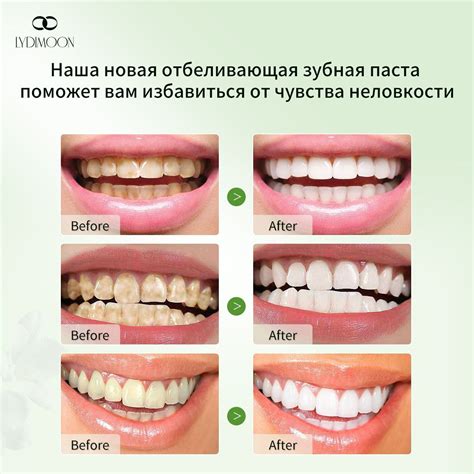 Пробиотическая отбеливающая зубная паста осветляющая пятно,удаляющая ...