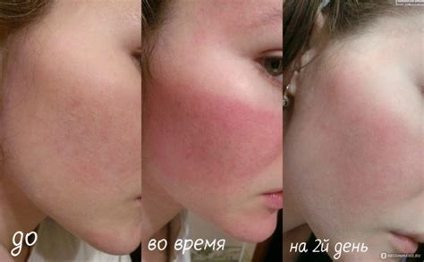 Что делать если содрала кожу после пилинга – почему нельзя отрывать
