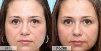 Как убрать грыжи под глазами: народные и современные методы