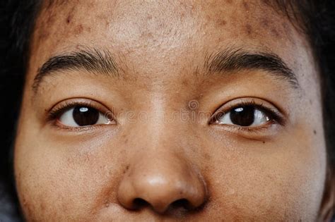 Woman with Acne Scars on Face Stock Image - Image of spots, young ...
