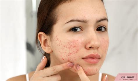 How to Treat Different Types of Acne? | Eve Therapy
