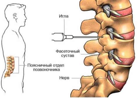 Уколы для лечения остеохондроза поясничного отдела позвоночника: список ...