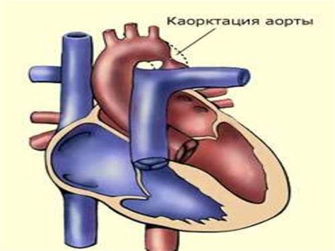 Аорта коартациясы - online presentation