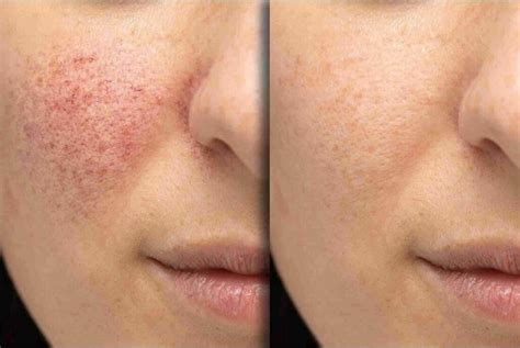 Laser Genesis - Utah Valley Dermatology