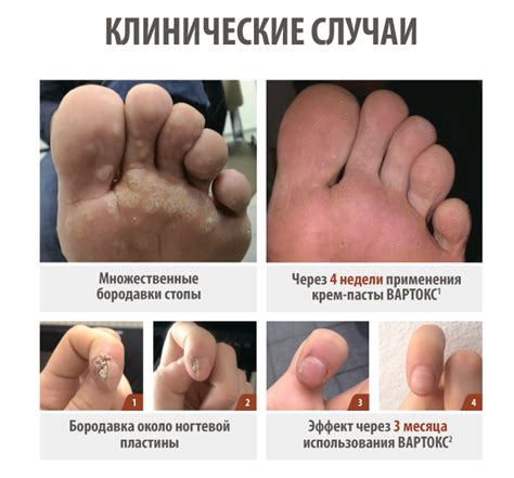 Вартокс® крем-паста от подошвенных бородавок. Официальный сайт