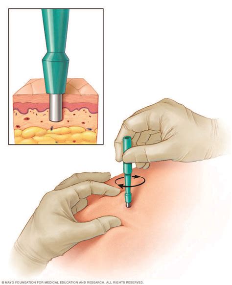 PUNCH PARA BIOPSIA - Import Vélez
