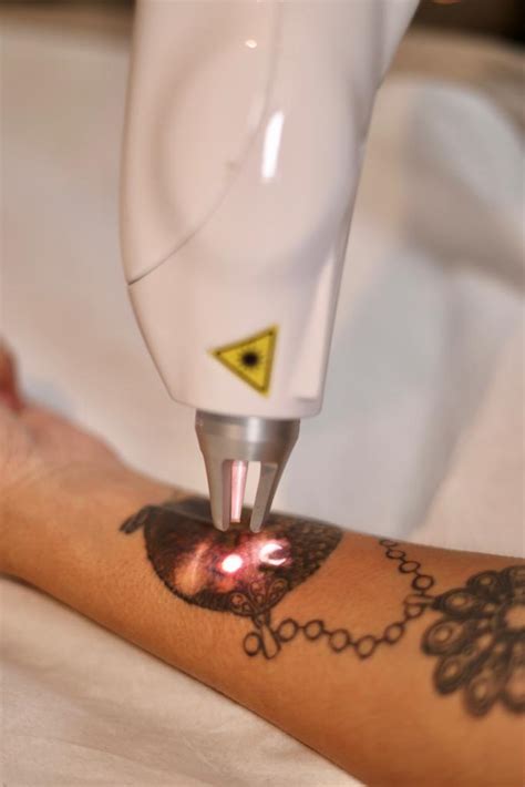 Be U Studio | Tattoo Removal in Clapham, London