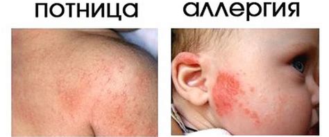 Как отличить потницу от аллергии у грудничка (15 фото): потничка и ...