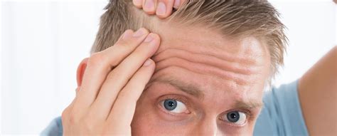 Early Signs Of Hair Loss To Look Out For - Stagger